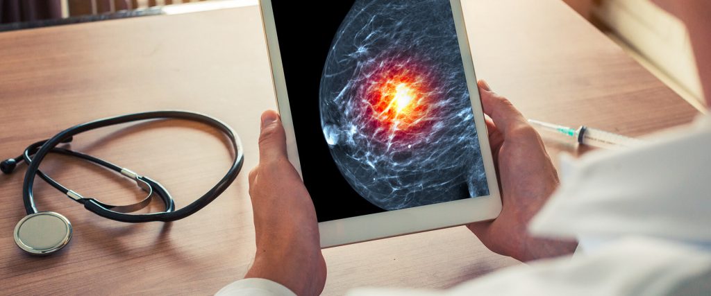 O que é mastectomia: O que é e quais são os tipos - Dr. Guilherme Novita